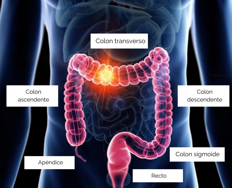 Que Es El Cancer De Colon