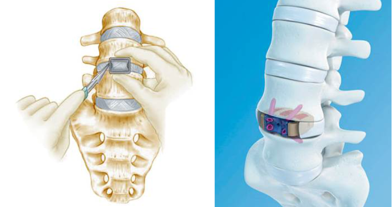 Artificial disk and disk replacement of the lumbar spine | Centro ...