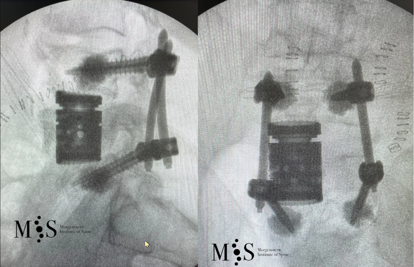 Vertebral Fractures | Centro Médico Teknon