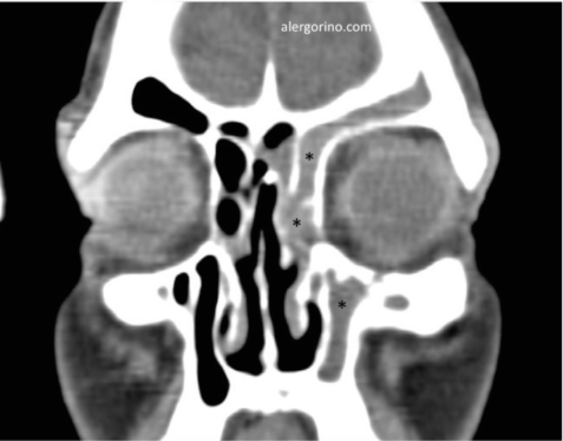 Sinusitis crónica | Centro Médico Teknon
