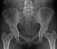 RX Pelvis | Centro Médico Teknon