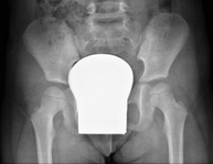 RX Caderas pediatría | Centro Médico Teknon