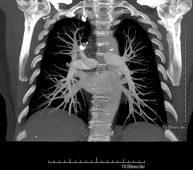 Angio-TC Arterias pulmonares (Estudio Tep, Tromboembolismo Pulmonar ...