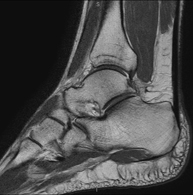 RM Tobillo | Centro Médico Teknon