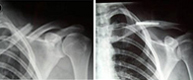 Fracturas de clavícula | Centro Médico Teknon