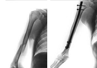 Fracturas del brazo | Centro Médico Teknon