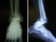 Fracturas del tobillo | Centro Médico Teknon