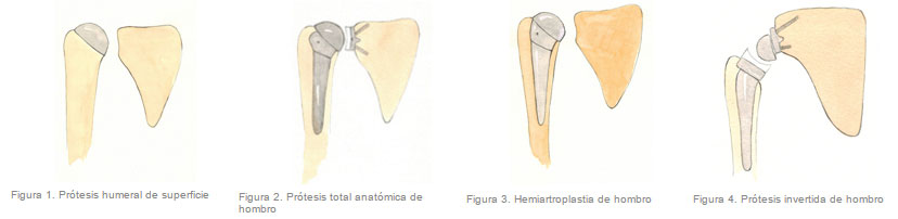 Prótesis de hombro | Centre Mèdic Teknon